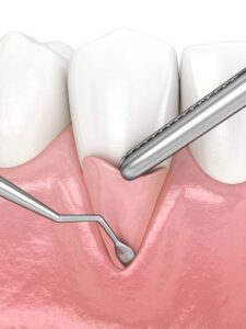 Zahnfleischaufbau | Kieferchirurgie Leipzig