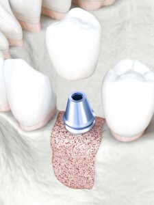 Knochenaufbau | Kieferchirurgie Leipzig