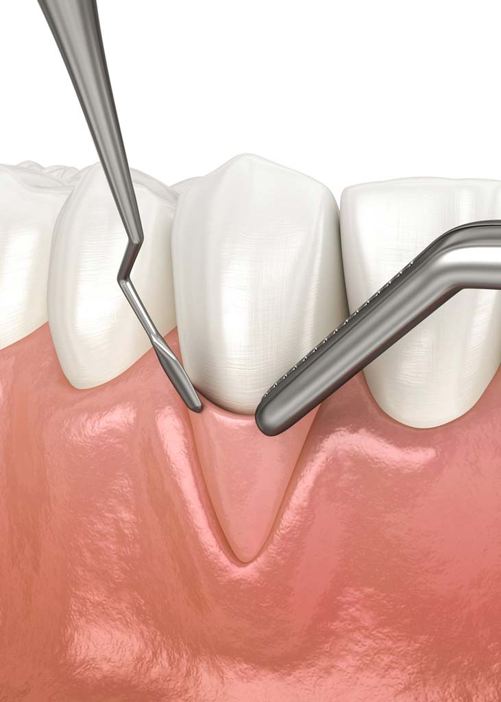 Regenerative Parodontalchirurgie | Kieferchirurgie Leipzig