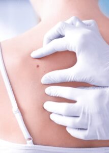 Muttermalentfernung durch Spezialisten | Gesichtschirurgie Leipzig